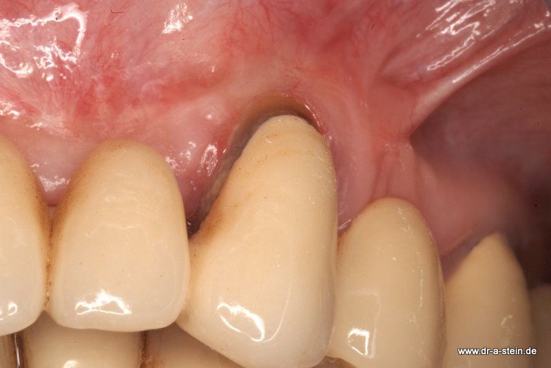 Rezessionen - Dr. Andreas Stein, Zahnarzt, Oralchirurgie Wiesbaden