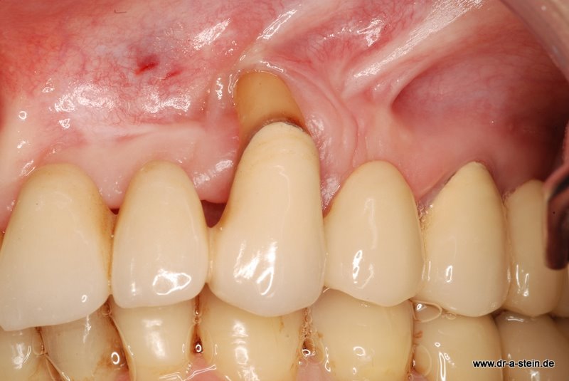 Rezessionen - Dr. Andreas Stein, Zahnarzt, Oralchirurgie Wiesbaden